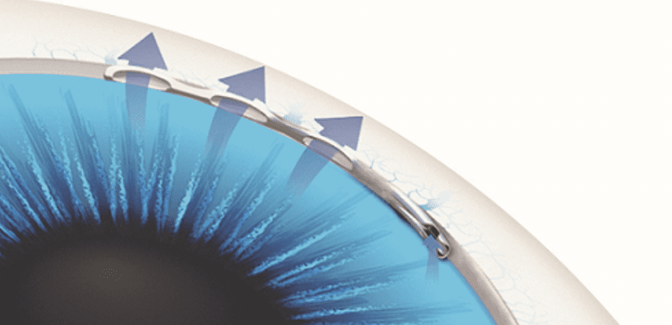 Hydrus Glaucoma Stent: A New Hope - Dr Geoffrey Ryan